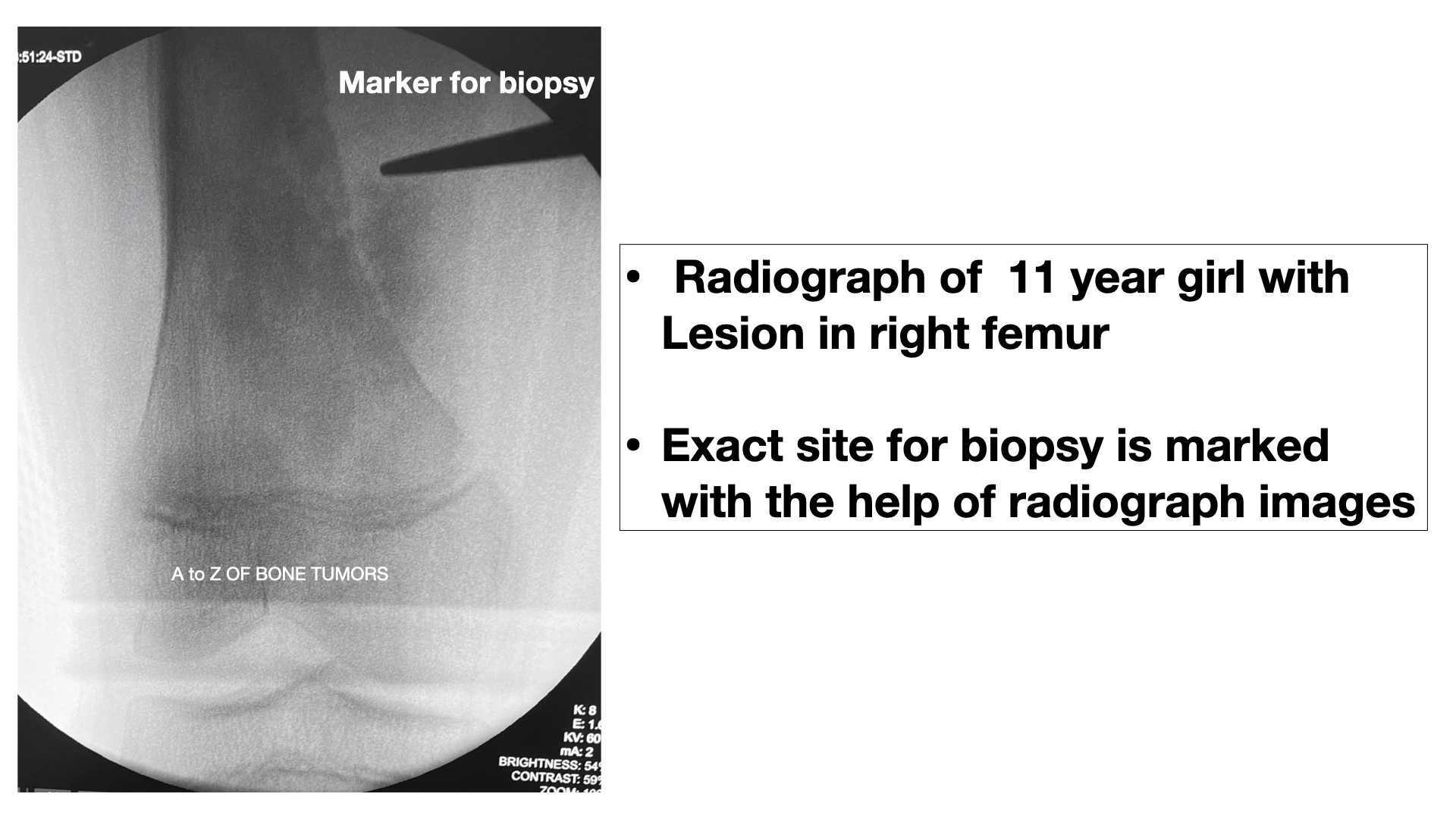 Bone Biopsy: What is this medical test or procedure? - Cancer Complete Care